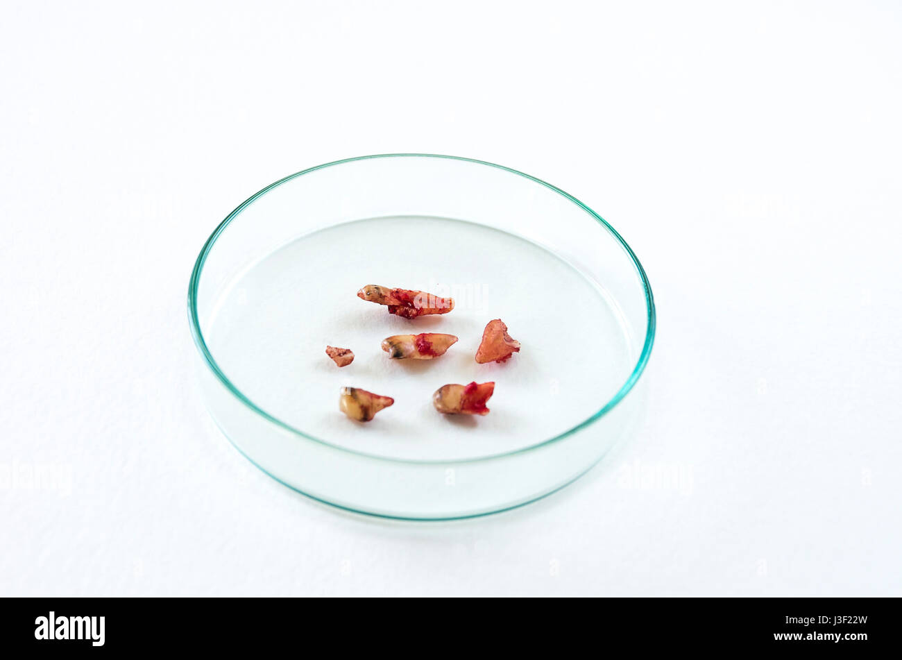Fragments of a human tooth after extraction in a petri dish Stock Photo ...