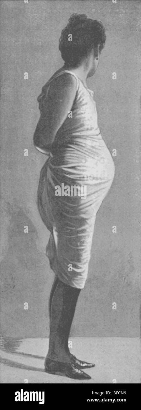 'Femme maigre enteroptose' refers to a condition known as enteroptosis ...