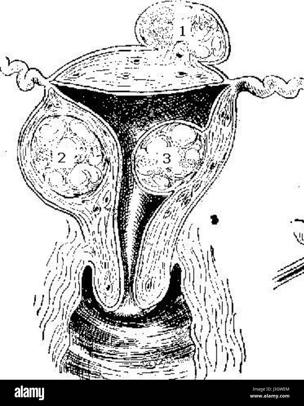 Fibroid Black and White Stock Photos & Images - Alamy