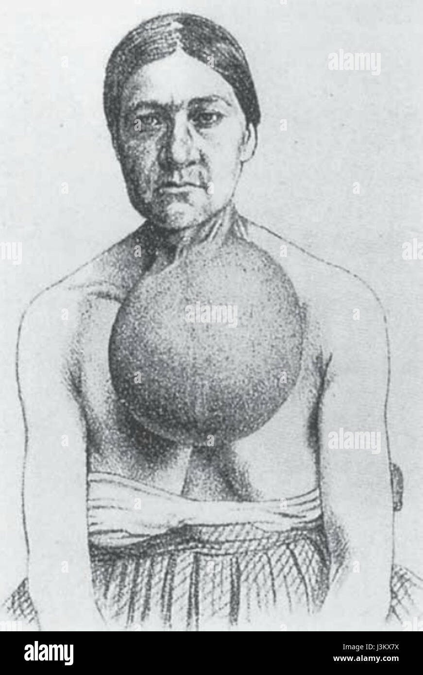 Goiter art hi-res stock photography and images - Alamy