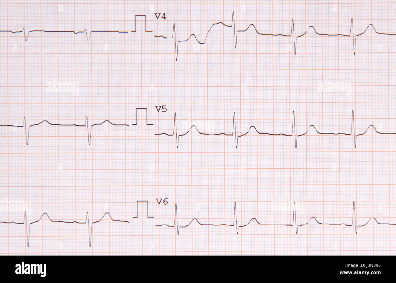 Close up electrocardiogram hi-res stock photography and images - Alamy