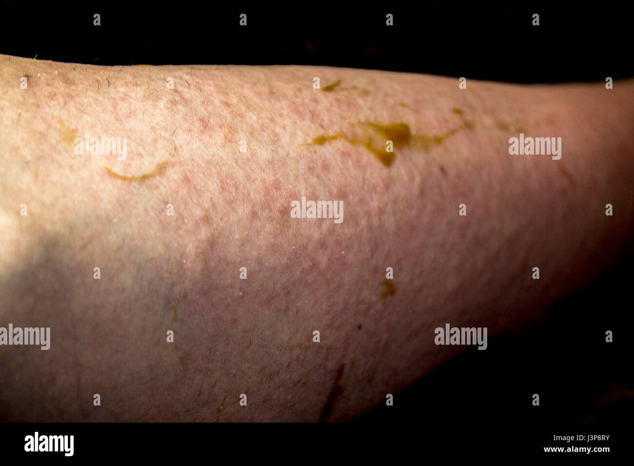 Sick skin on the girl on her leg Stock Photo - Alamy