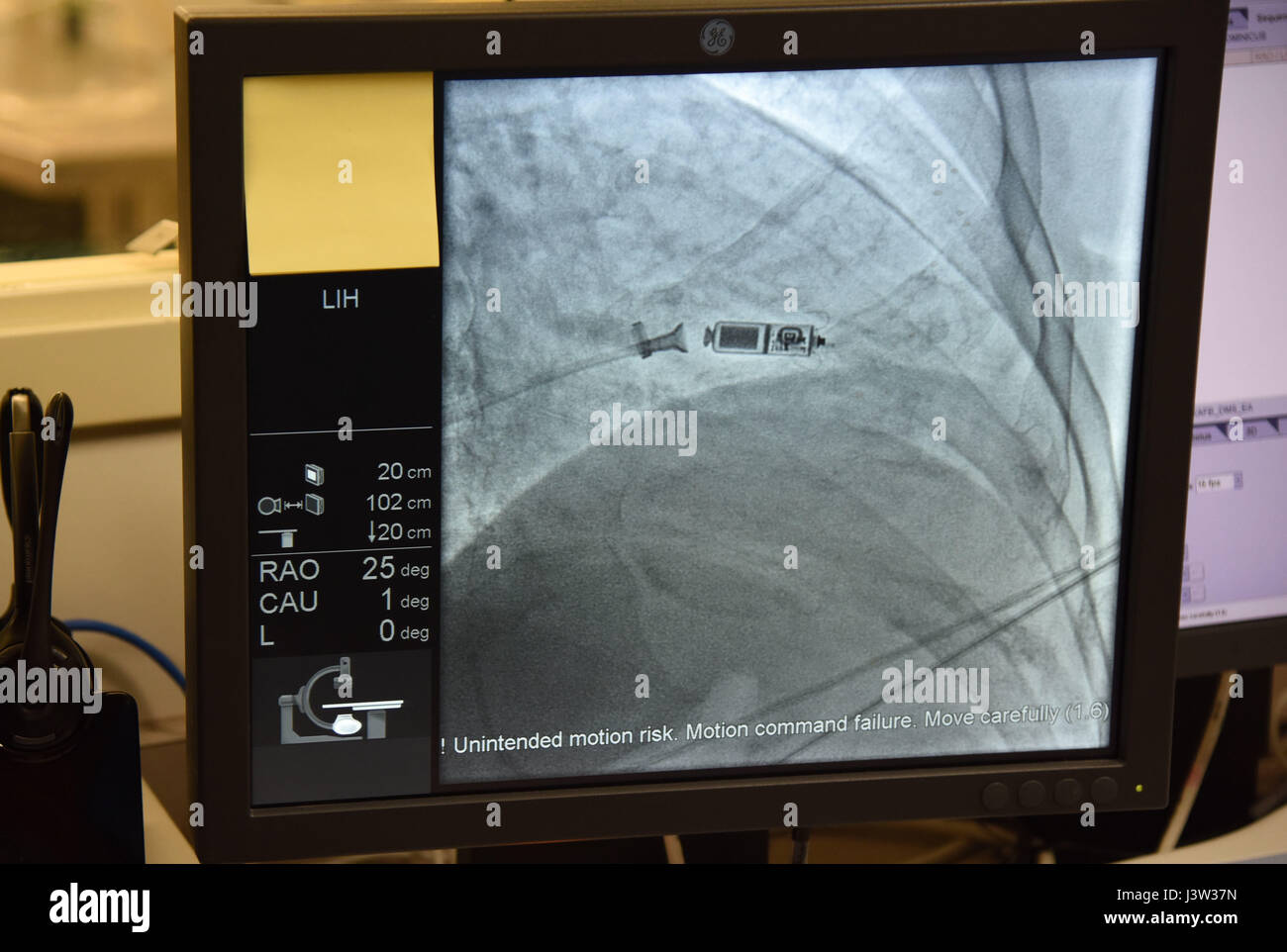 Medical professionals insert a Micra Transcatheter Pacing System into a ...