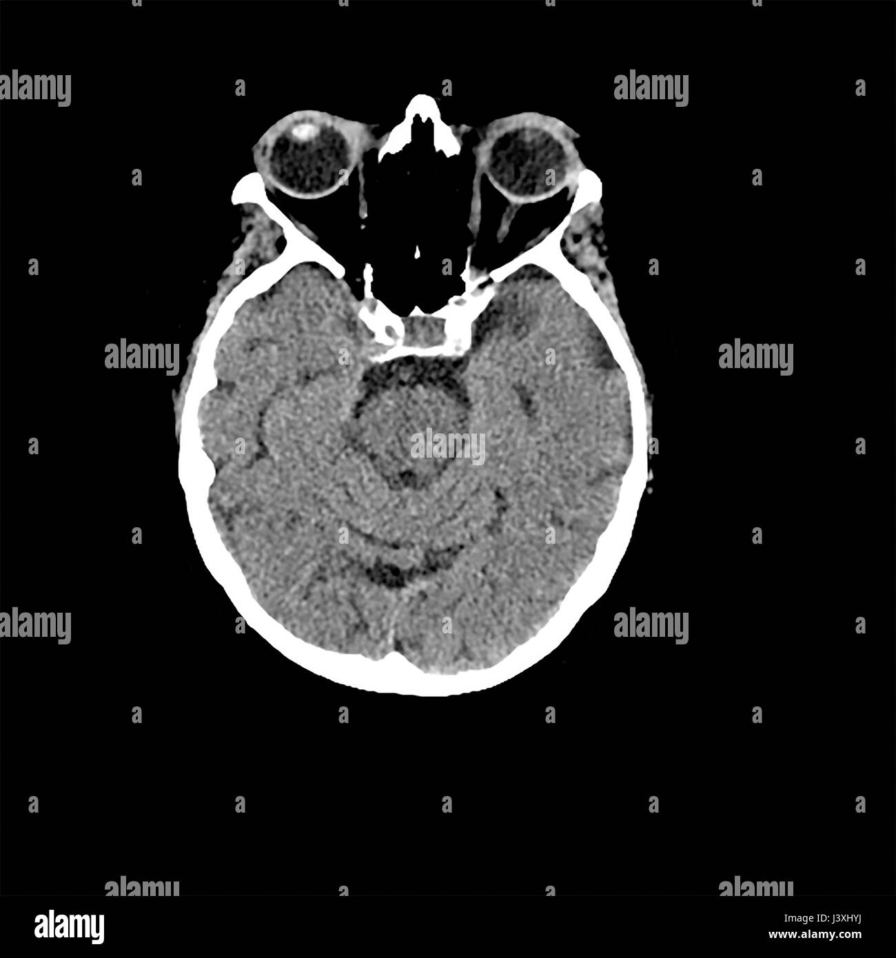Head CT scan of an 85 year old female patient with signs of dementia ...