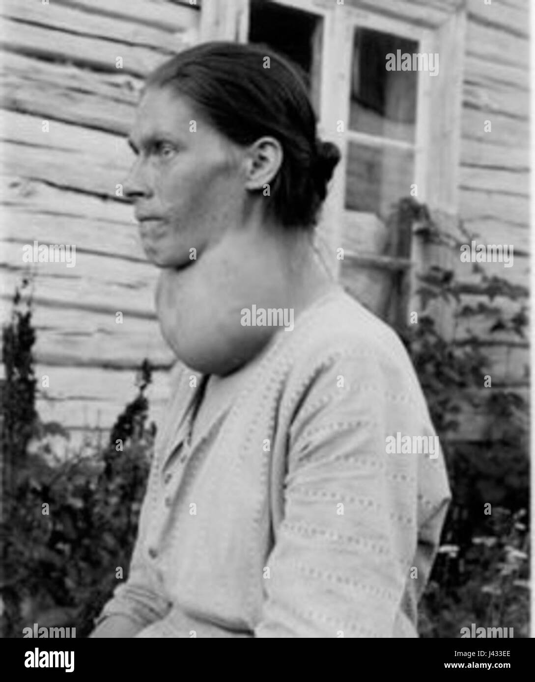 A medical condition called *Kone med stor struma*, likely describing a ...