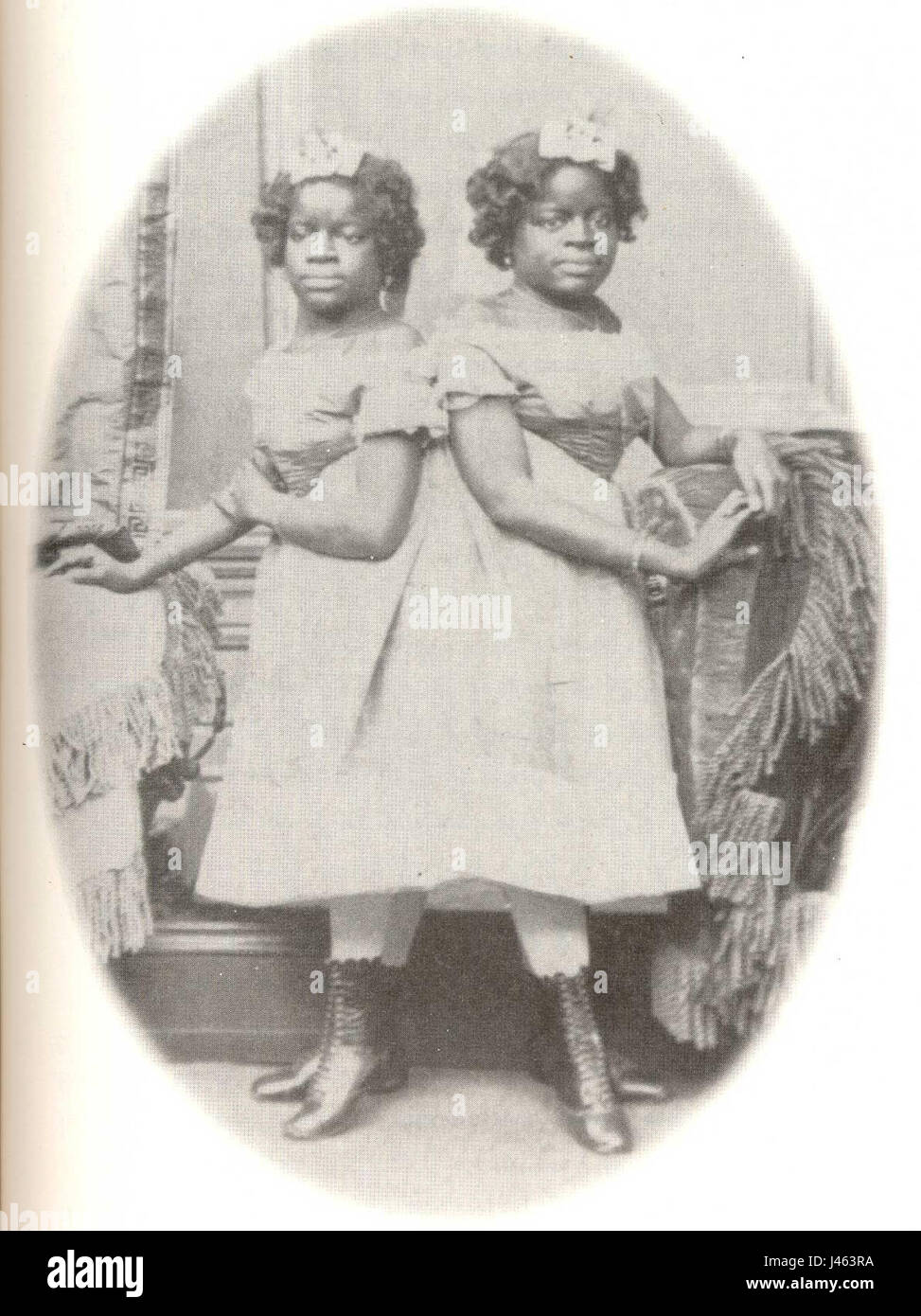 Millie and Christine McCoy were conjoined twins born in 1851, known for ...
