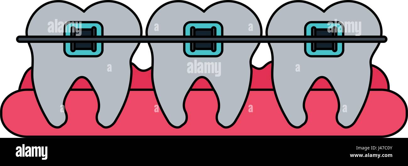 color image cartoon set gum with tooth view and orthodontics Stock ...