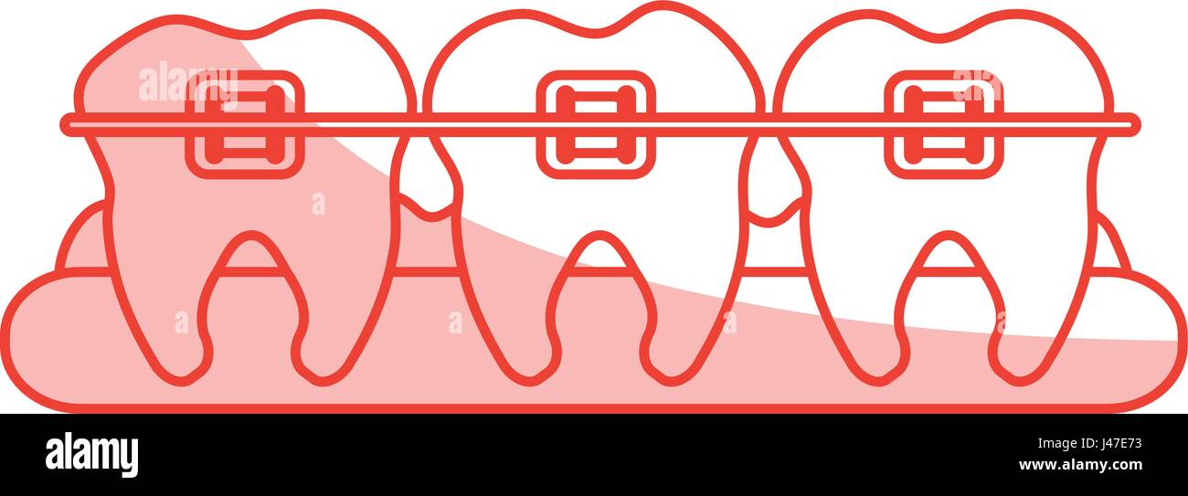 red shading silhouette cartoon set gum with tooth view and orthodontics ...