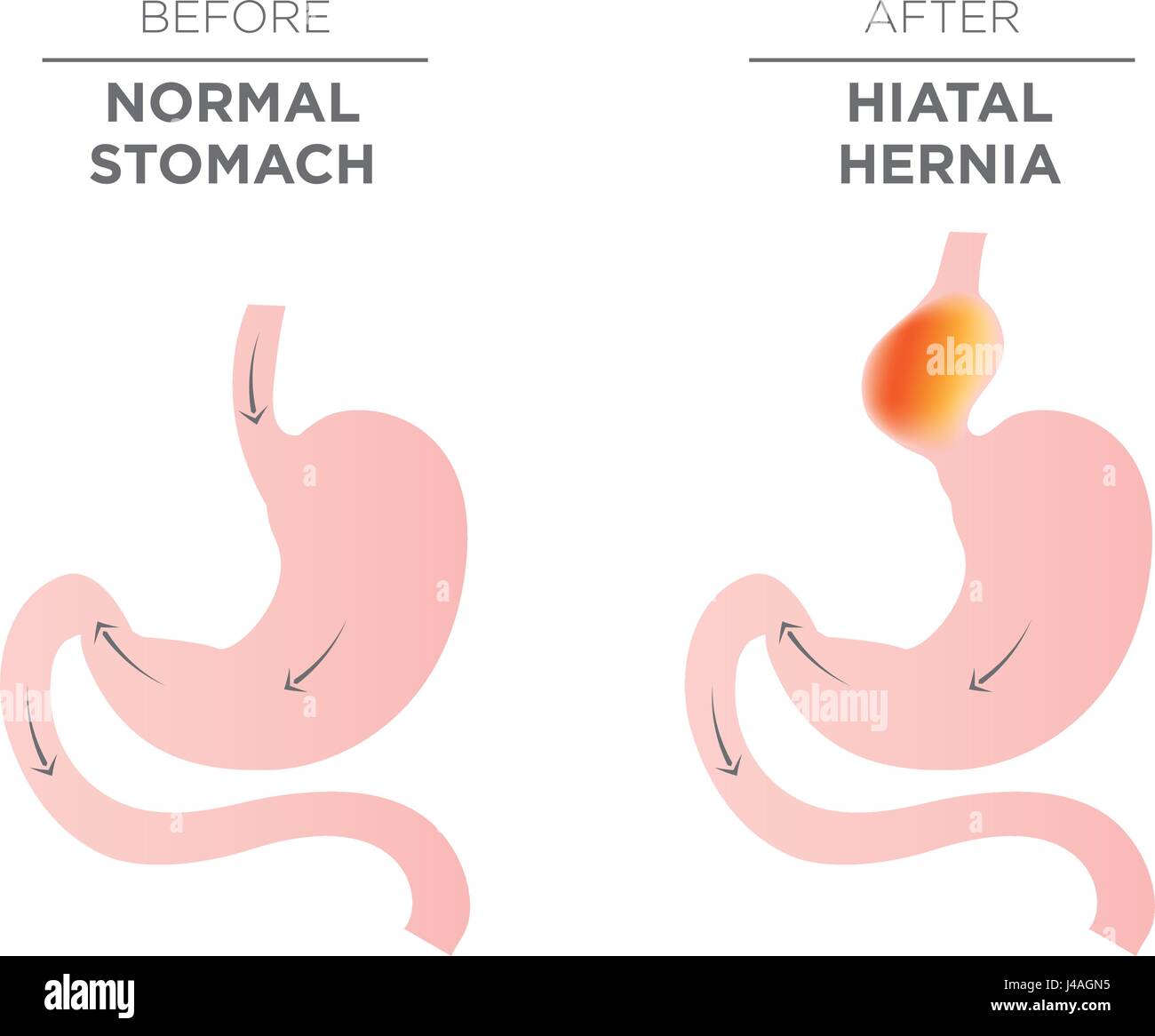 Hiatal hernia hi-res stock photography and images - Alamy