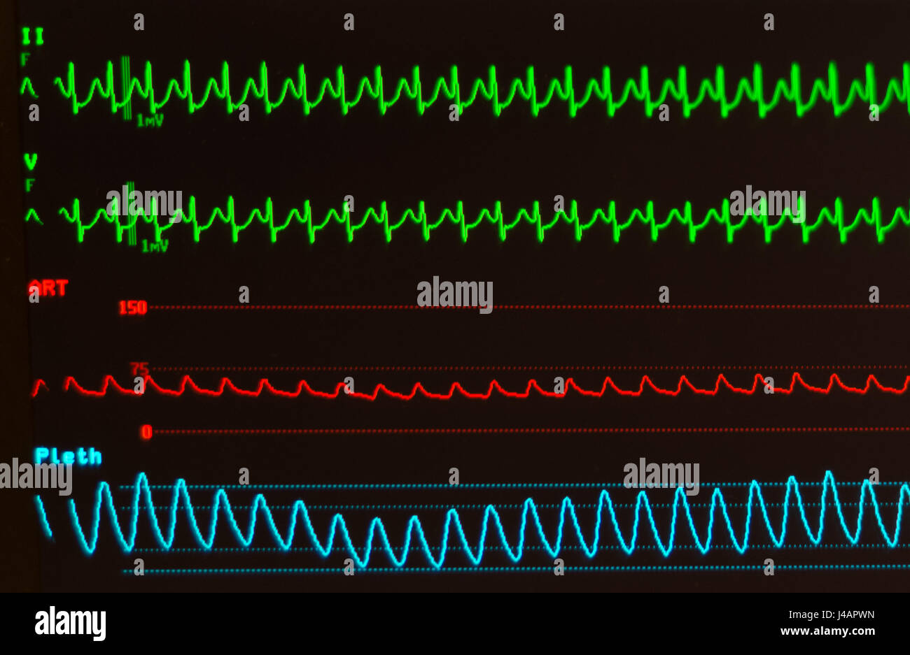 Black monitor with AVNRT/atrioventricular nodal reentrant tachycardia ...
