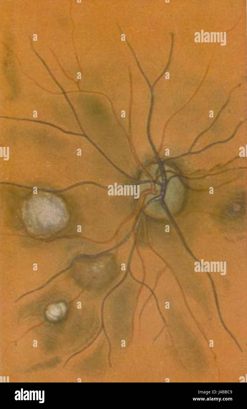 Retinal phakoma 1921 drawing jan hi-res stock photography and images ...