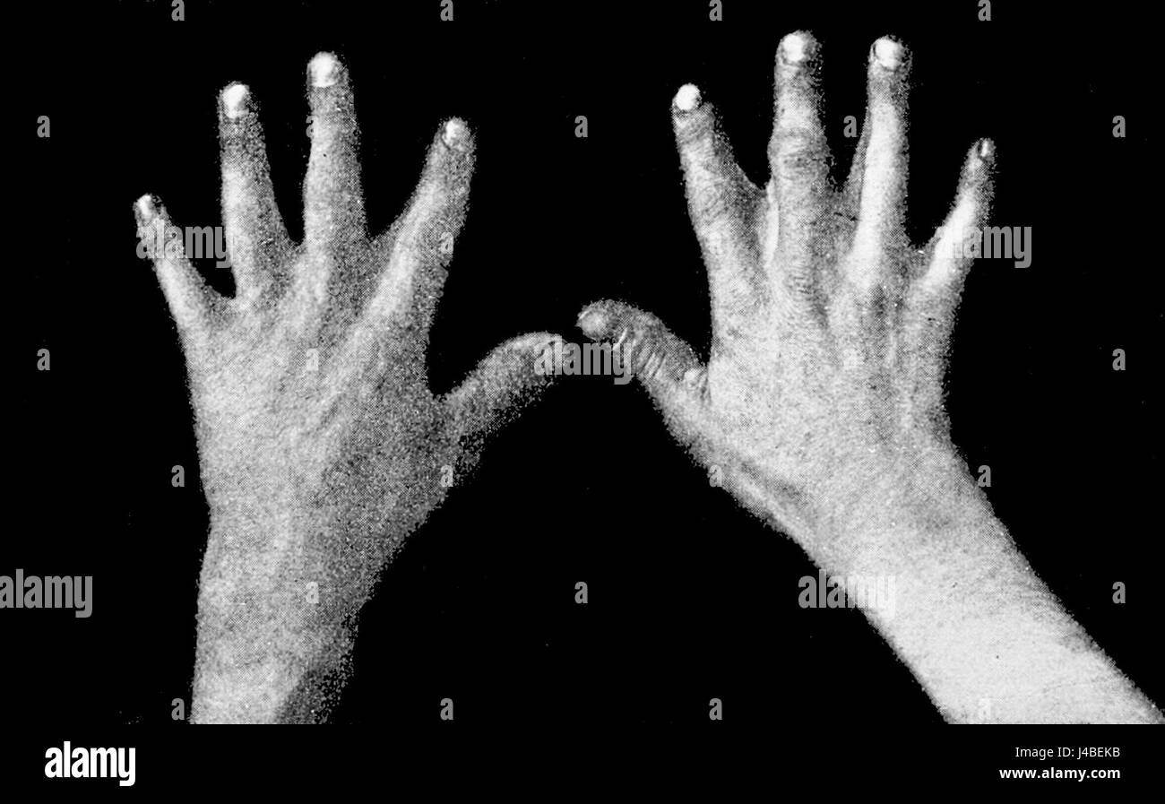 Webbed fingers Black and White Stock Photos & Images - Alamy