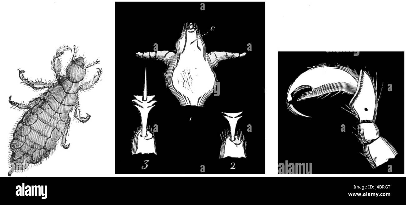 Human head lice infestation Black and White Stock Photos & Images - Alamy