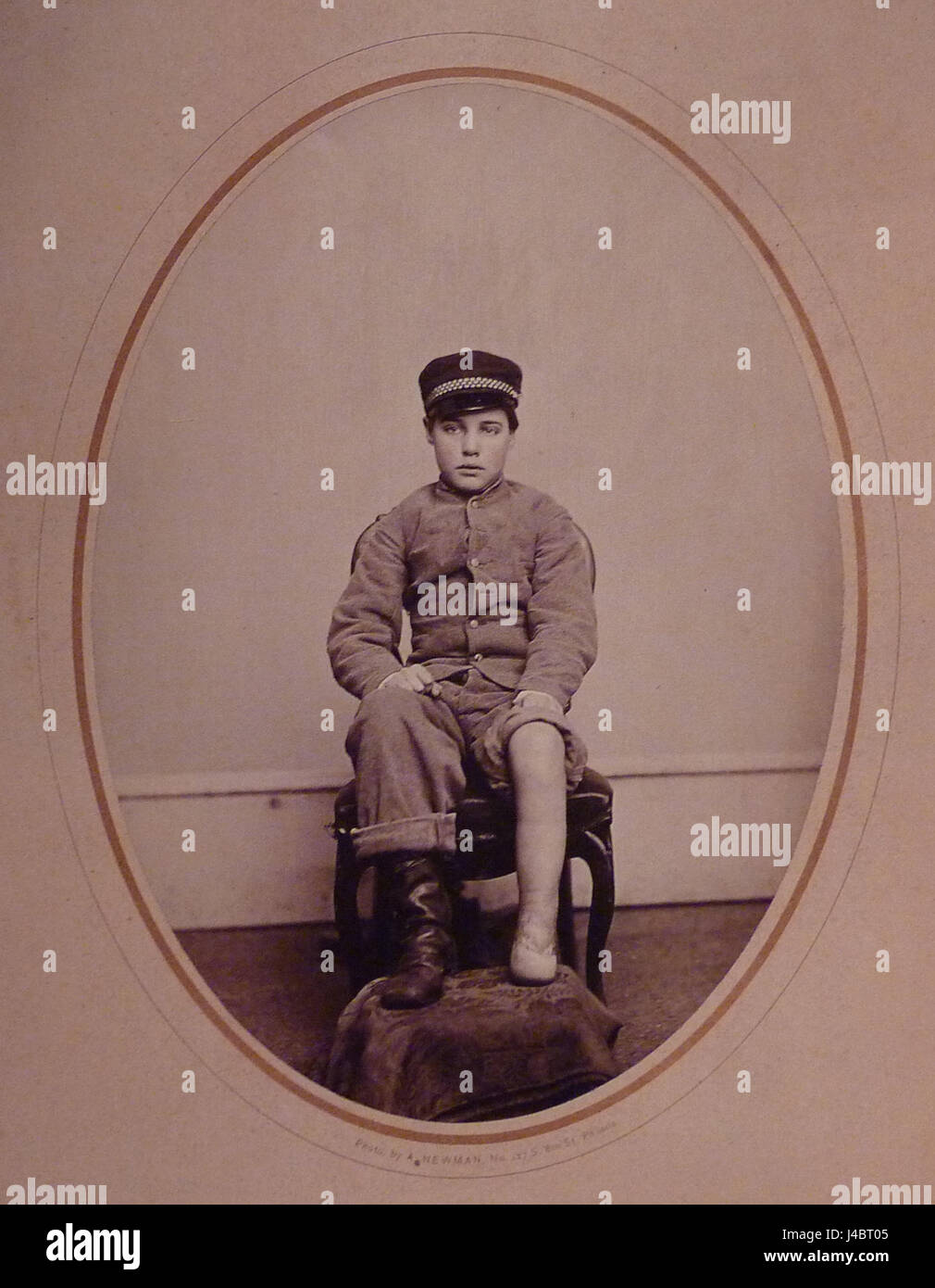 Pirogoff Amputation 2 Stock Photo - Alamy