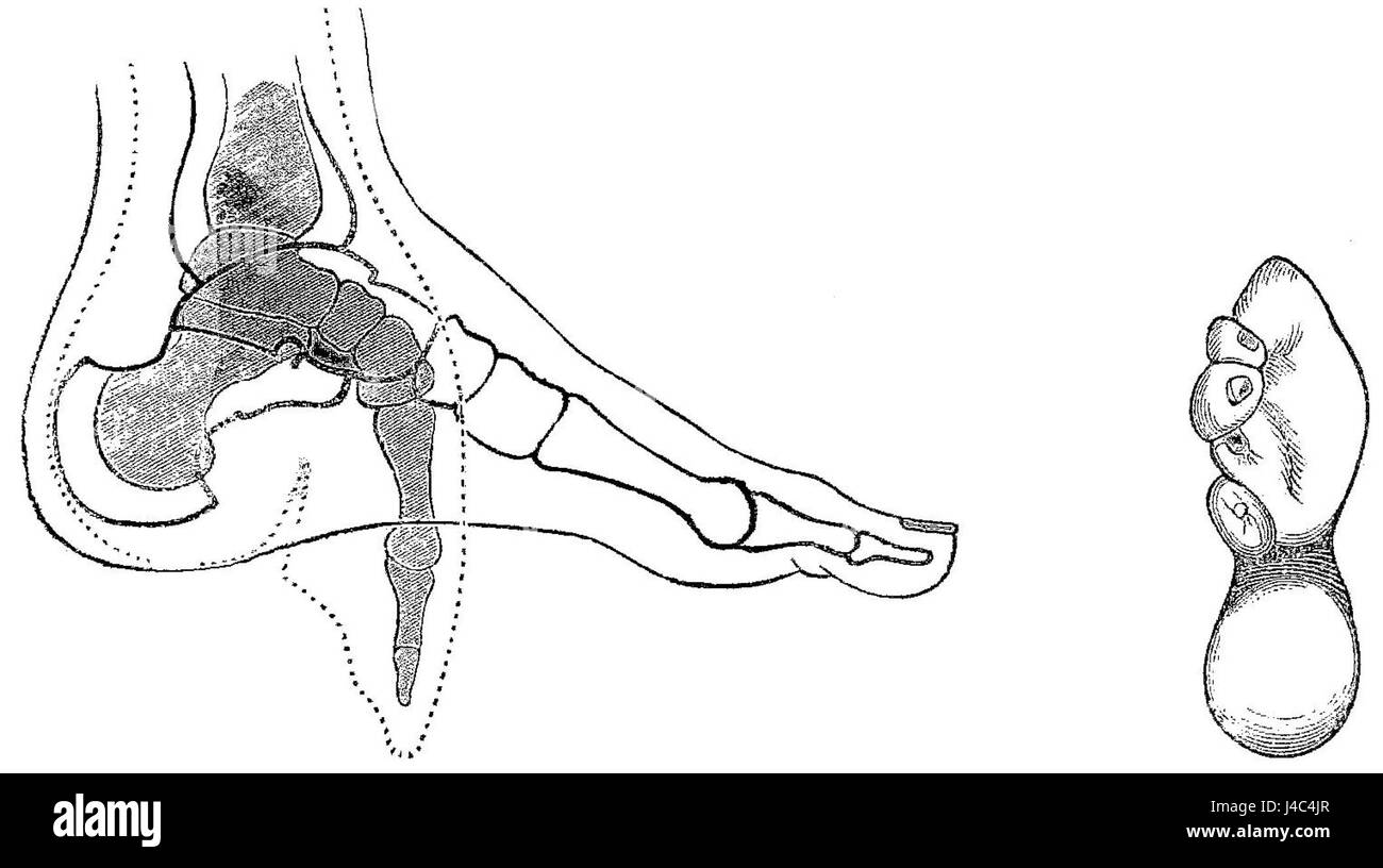 Womens foot Black and White Stock Photos & Images - Alamy