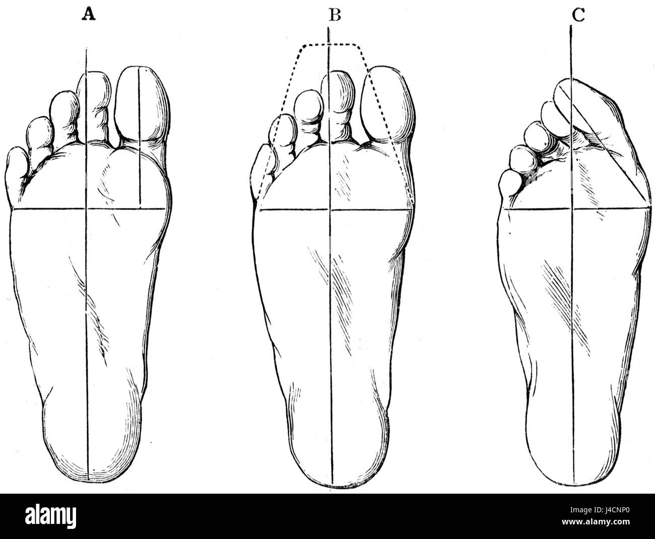 Orthotic Black and White Stock Photos & Images - Alamy