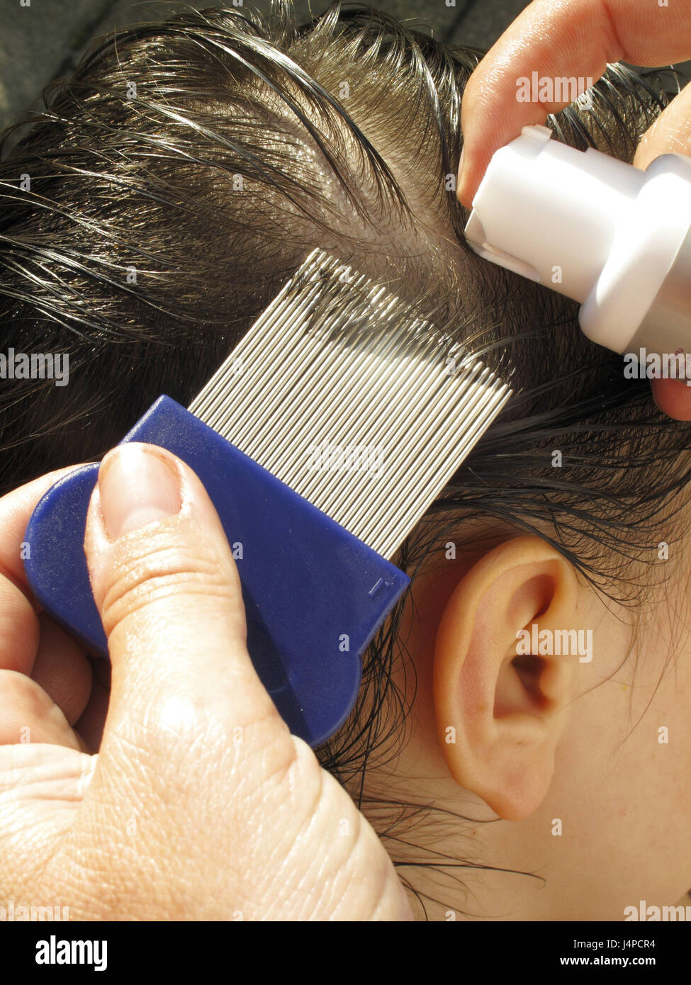 Child, head louses, mother, removal, lice, louse's neck, means, apply ...