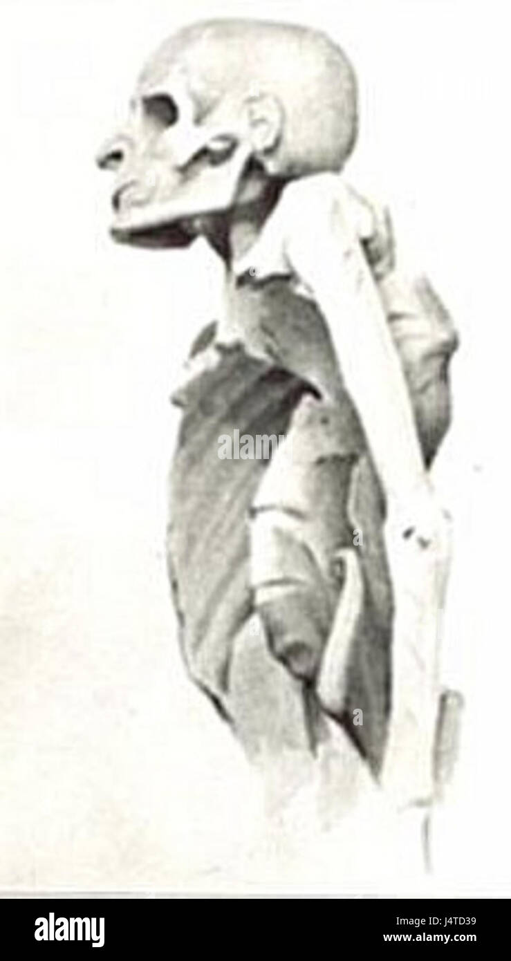 This mummified individual, believed to have suffered from tuberculosis ...