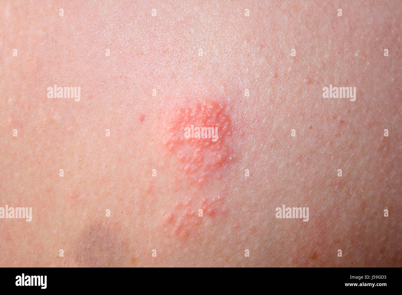 allergy test,intradermal test Stock Photo - Alamy