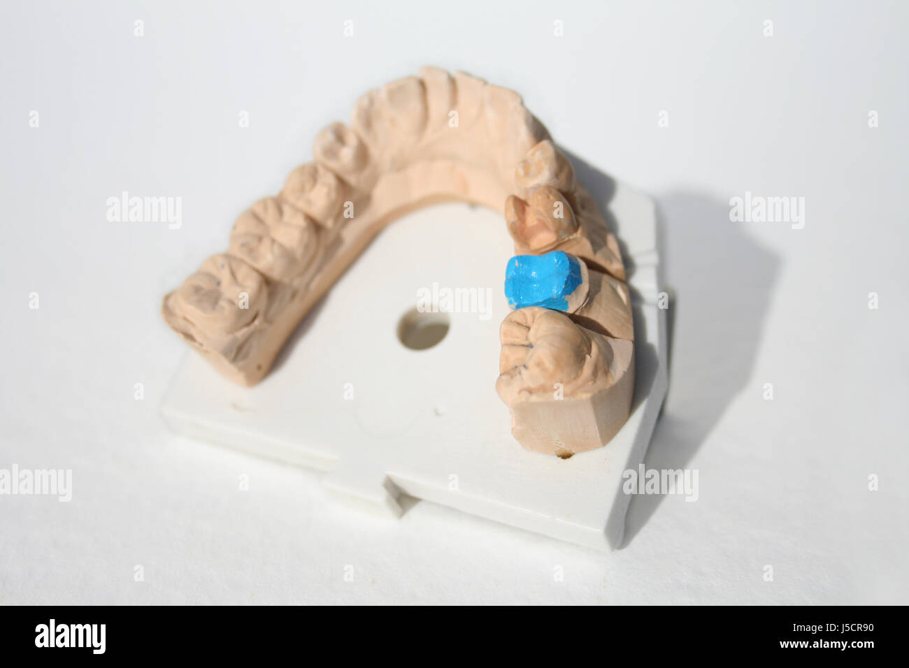 Gold crown tooth hi-res stock photography and images - Alamy
