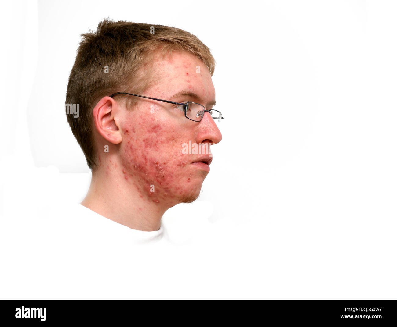 one week later - isotretinoin Stock Photo - Alamy