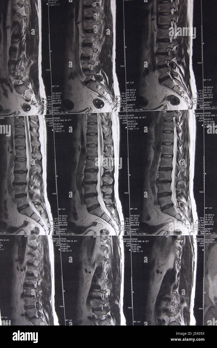 Herniated lumbar disc mri hi-res stock photography and images - Alamy