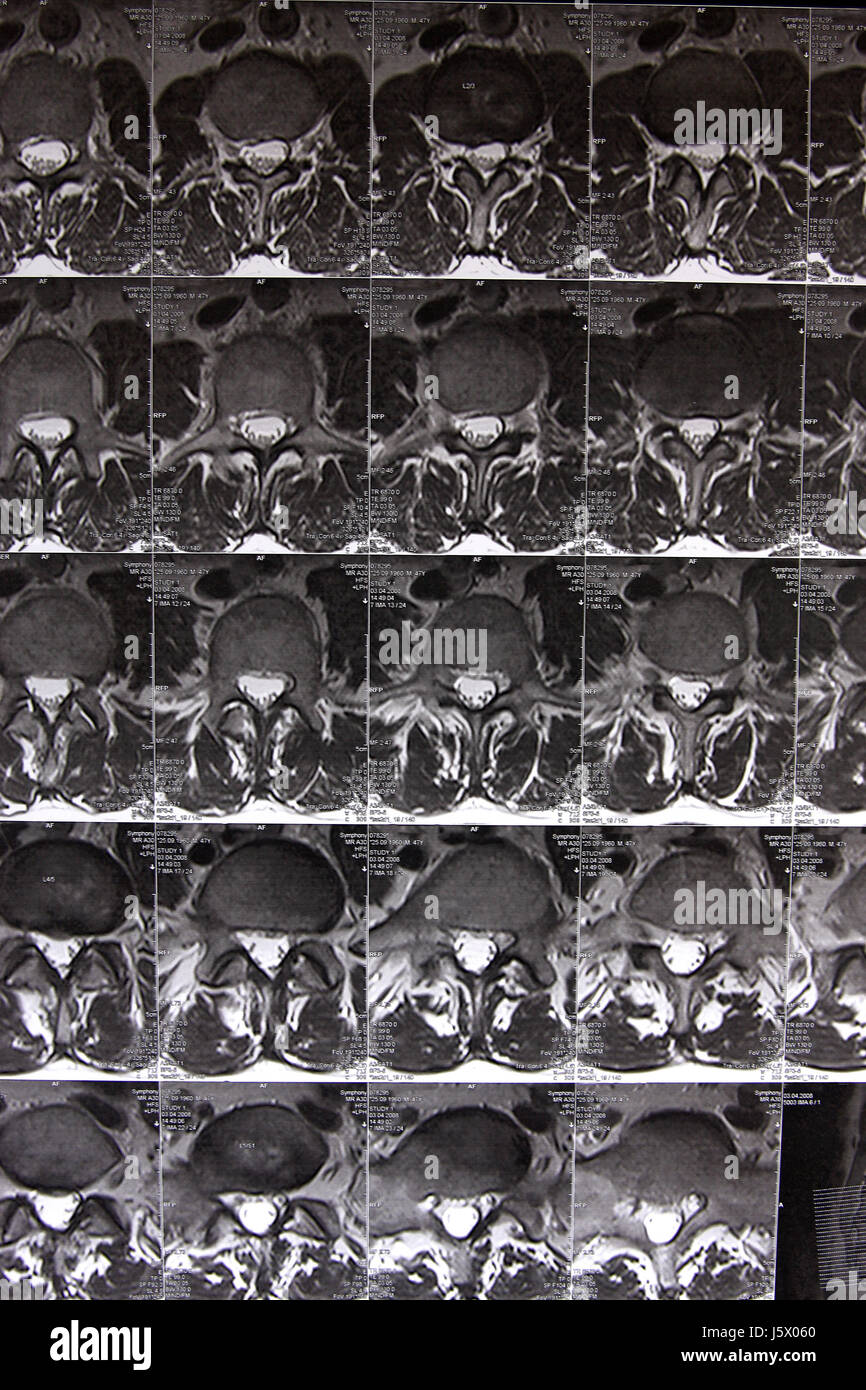 Mri of herniated disc hi-res stock photography and images - Alamy