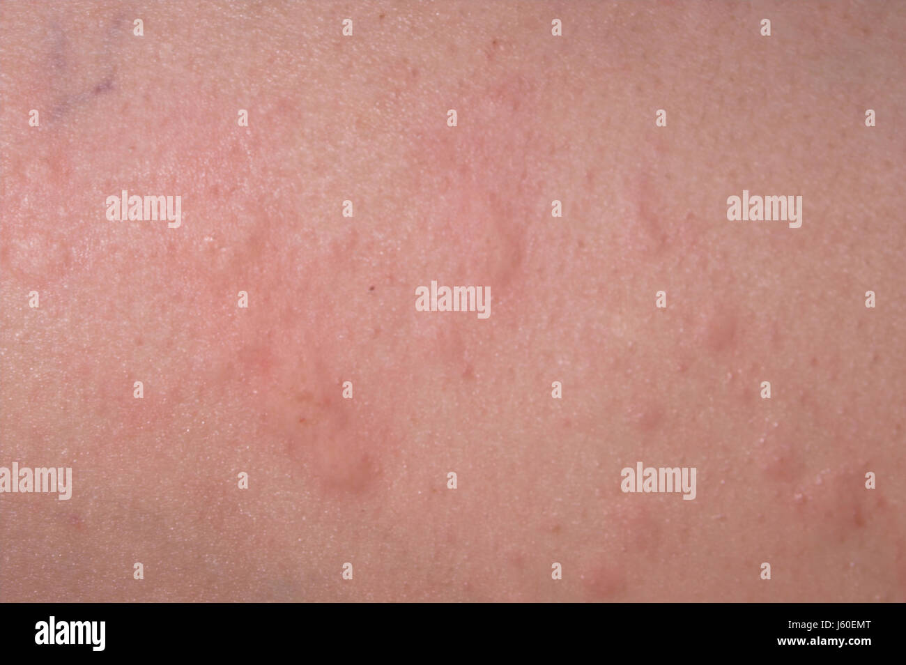 health medicinally medical itch hives allergy allergic healthcare care ...