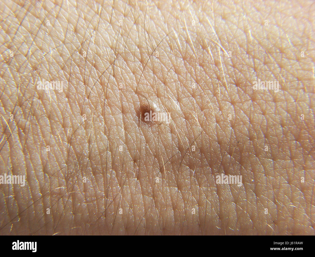 skin maladies birthmark mole skin maladies birthmark mole leberfleck ...