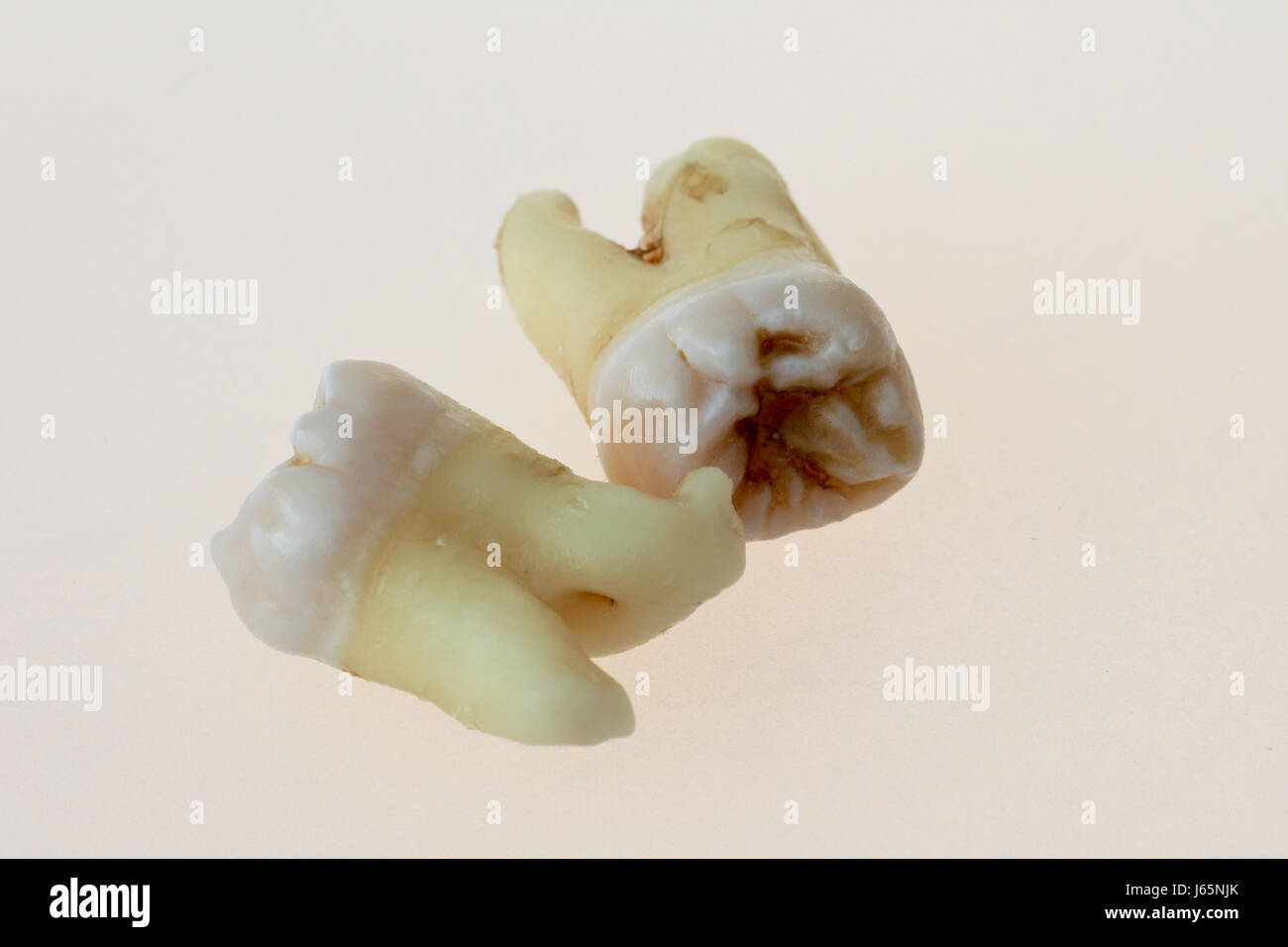 teeth tooth caries dentistry wisdom teeth wisdom tooth teeth tooth ...