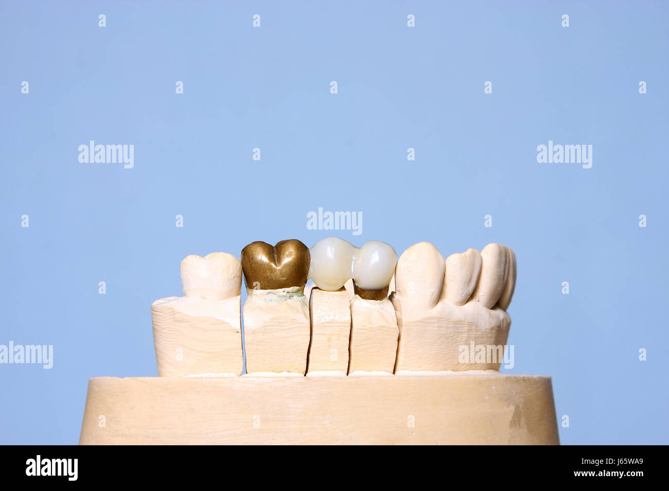 Gold teeth denture hi-res stock photography and images - Alamy