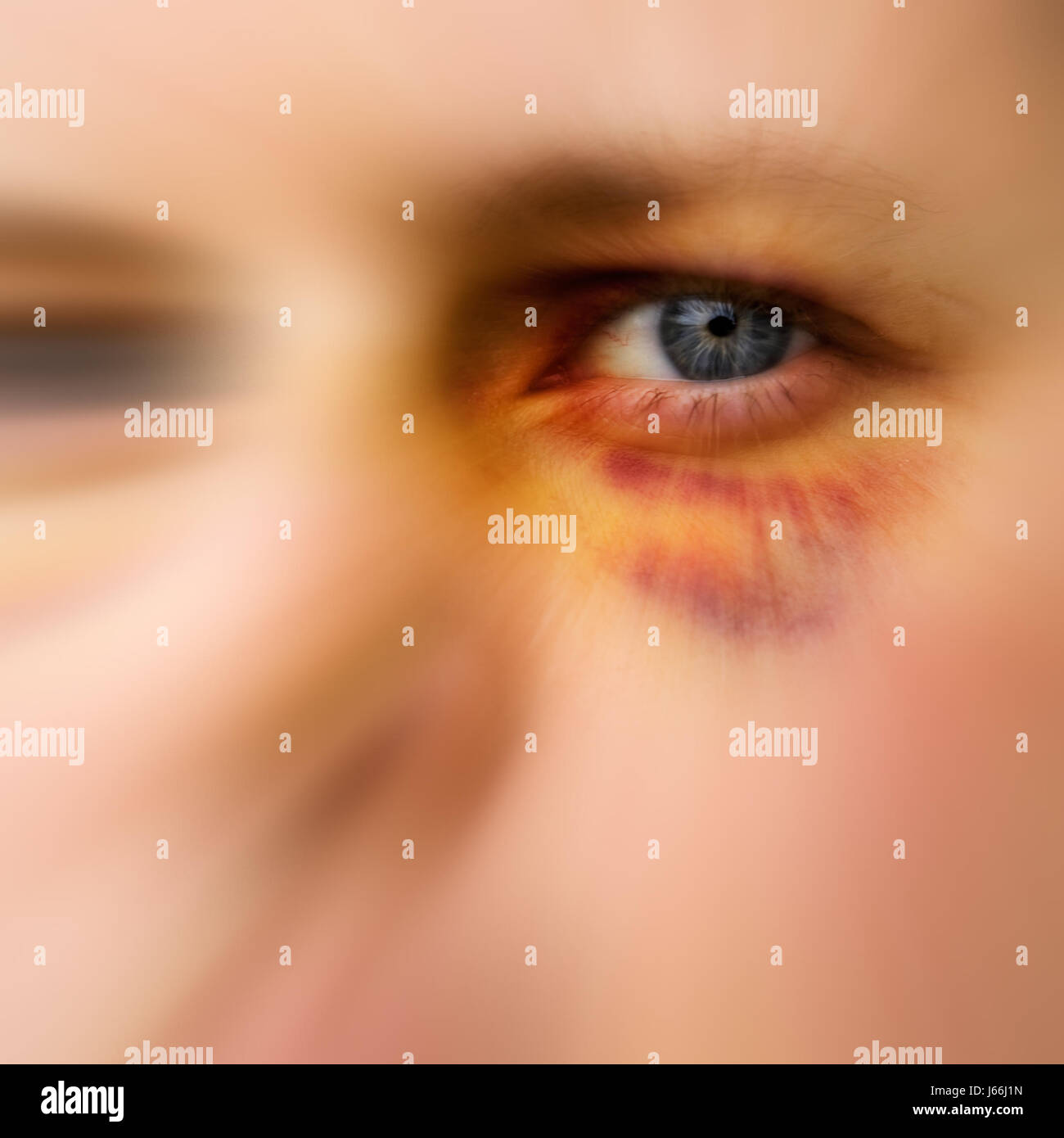 Woman black eye bruise hi-res stock photography and images - Alamy