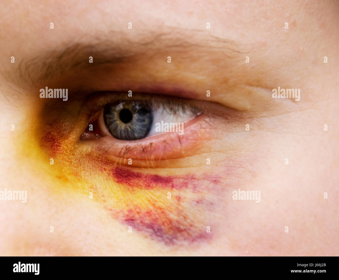 Abuse woman black eye hi-res stock photography and images - Alamy