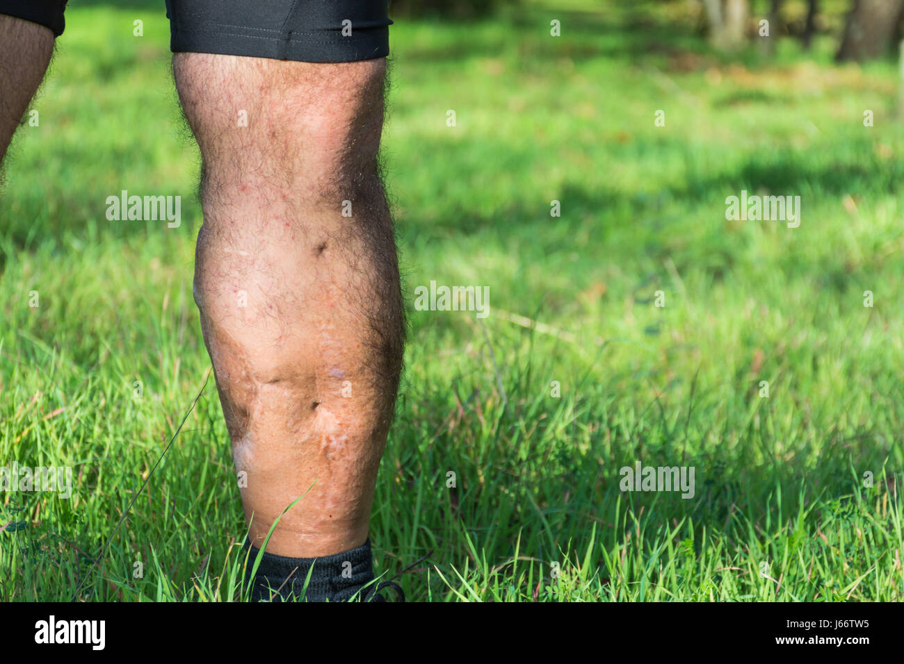 Old scar leg injury from hi-res stock photography and images - Alamy