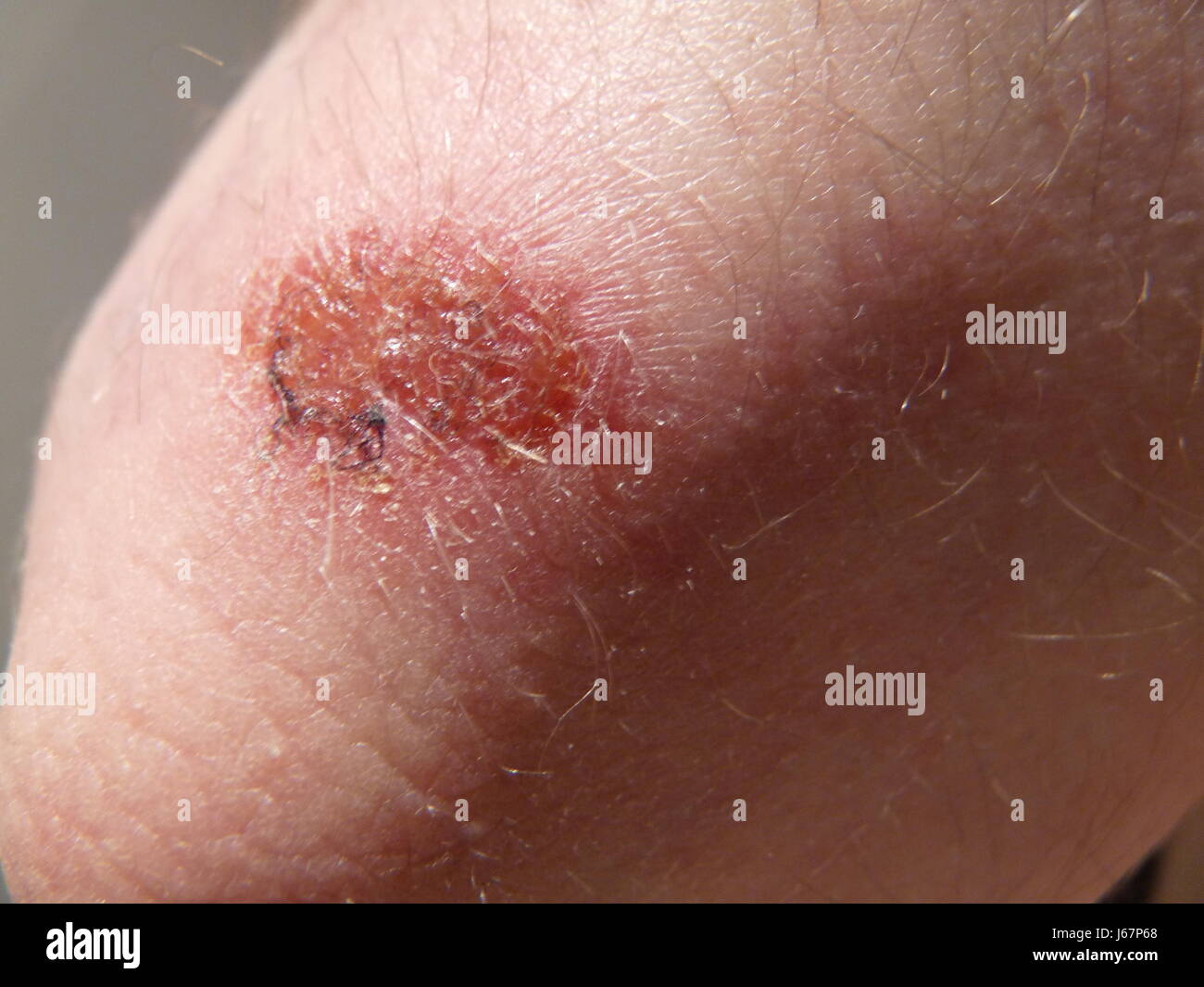 wound injury ache elbow arm sore blood dry dried up barren schrfwunde ...