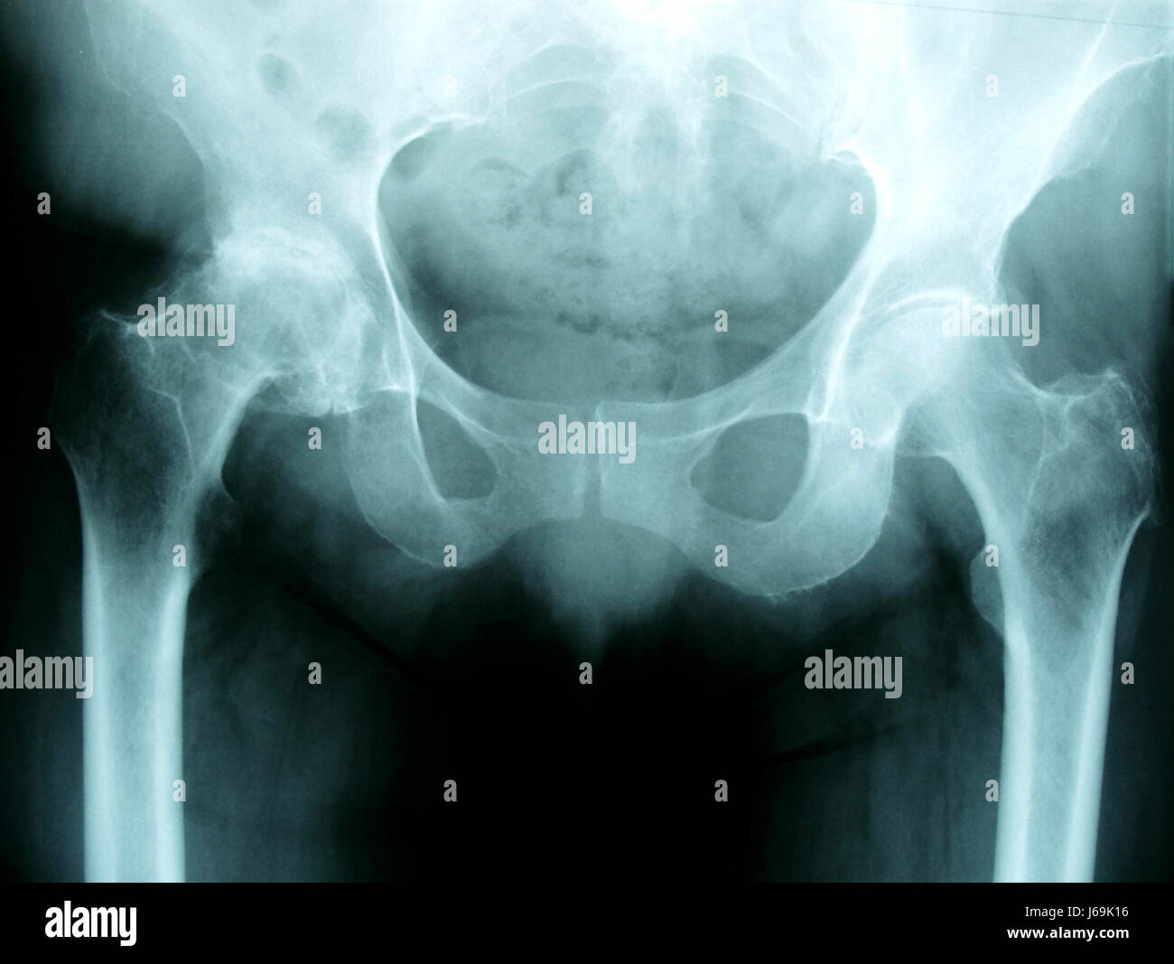 Radiograph of hip hi-res stock photography and images - Alamy