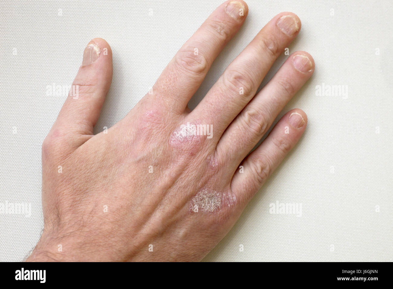 health skin disease psoriasis illness sickness hand health macro close ...