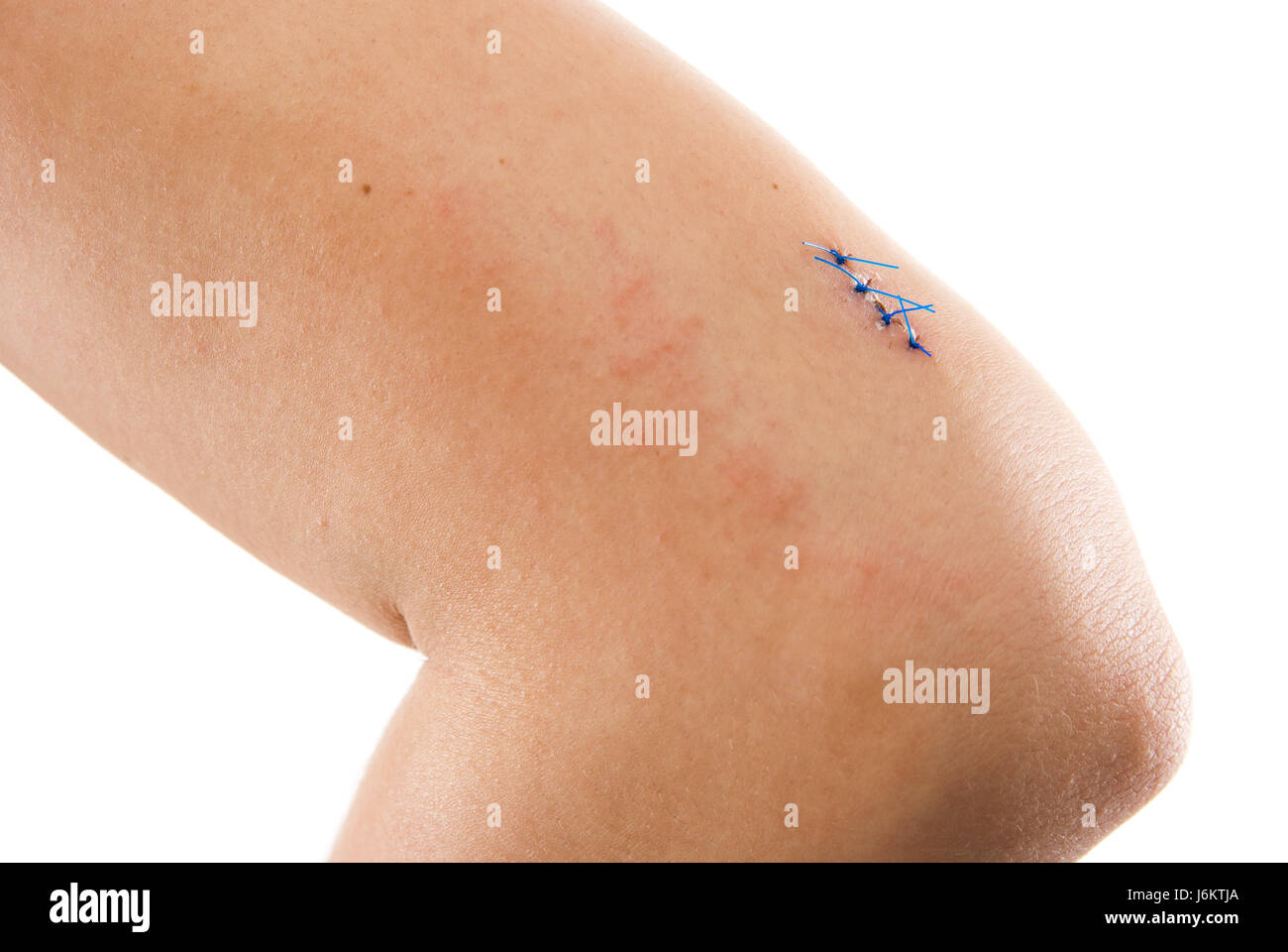 stitched up injury Stock Photo - Alamy