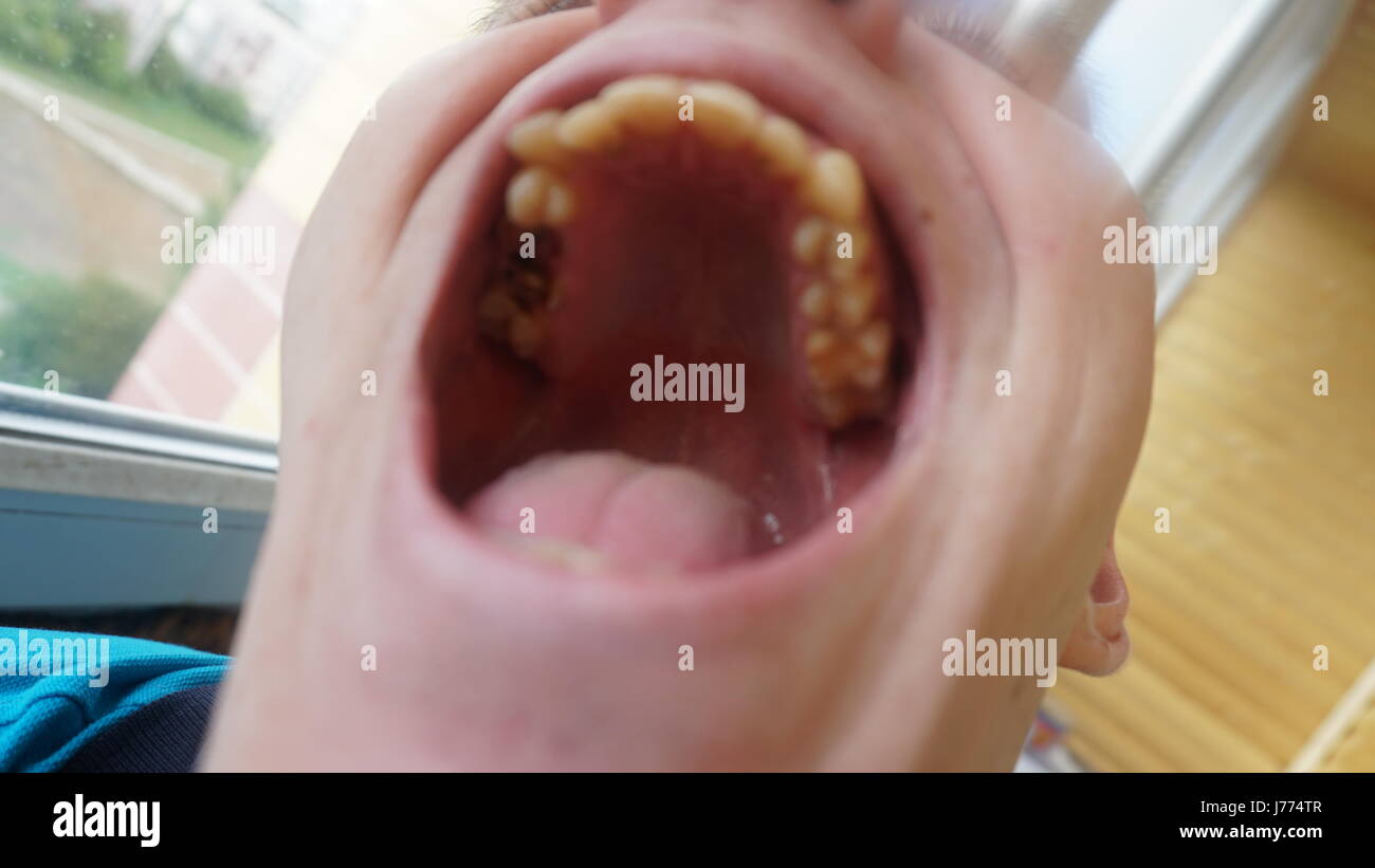 Bad teeth of a guy. Rotten and yellow teeth Stock Photo - Alamy