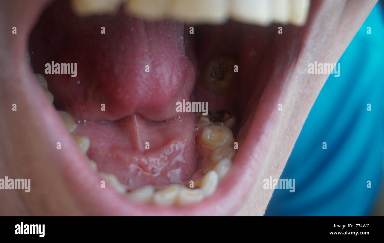 Bad teeth of a guy. Rotten and yellow teeth Stock Photo - Alamy