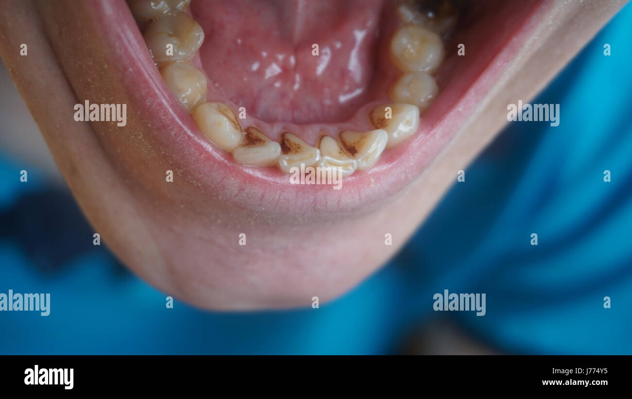 Bad teeth of a guy. Rotten and yellow teeth Stock Photo - Alamy