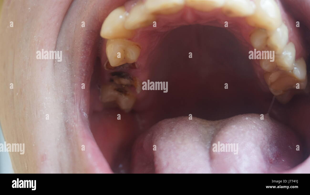 Bad teeth hi-res stock photography and images - Alamy