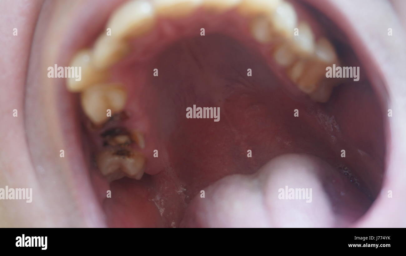 Bad teeth of a guy. Rotten and yellow teeth Stock Photo - Alamy