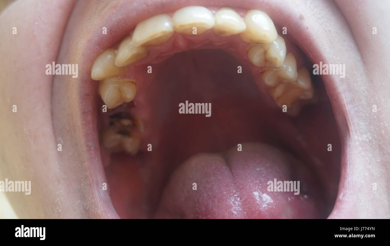 Bad teeth of a guy. Rotten and yellow teeth Stock Photo - Alamy