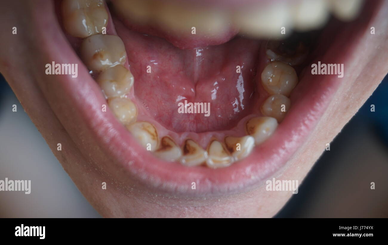 Bad teeth of a guy. Rotten and yellow teeth Stock Photo - Alamy