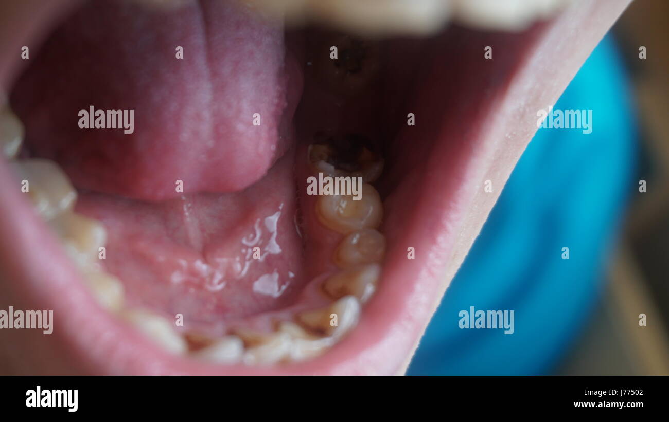 Bad teeth guy yellow teeth hi-res stock photography and images - Alamy