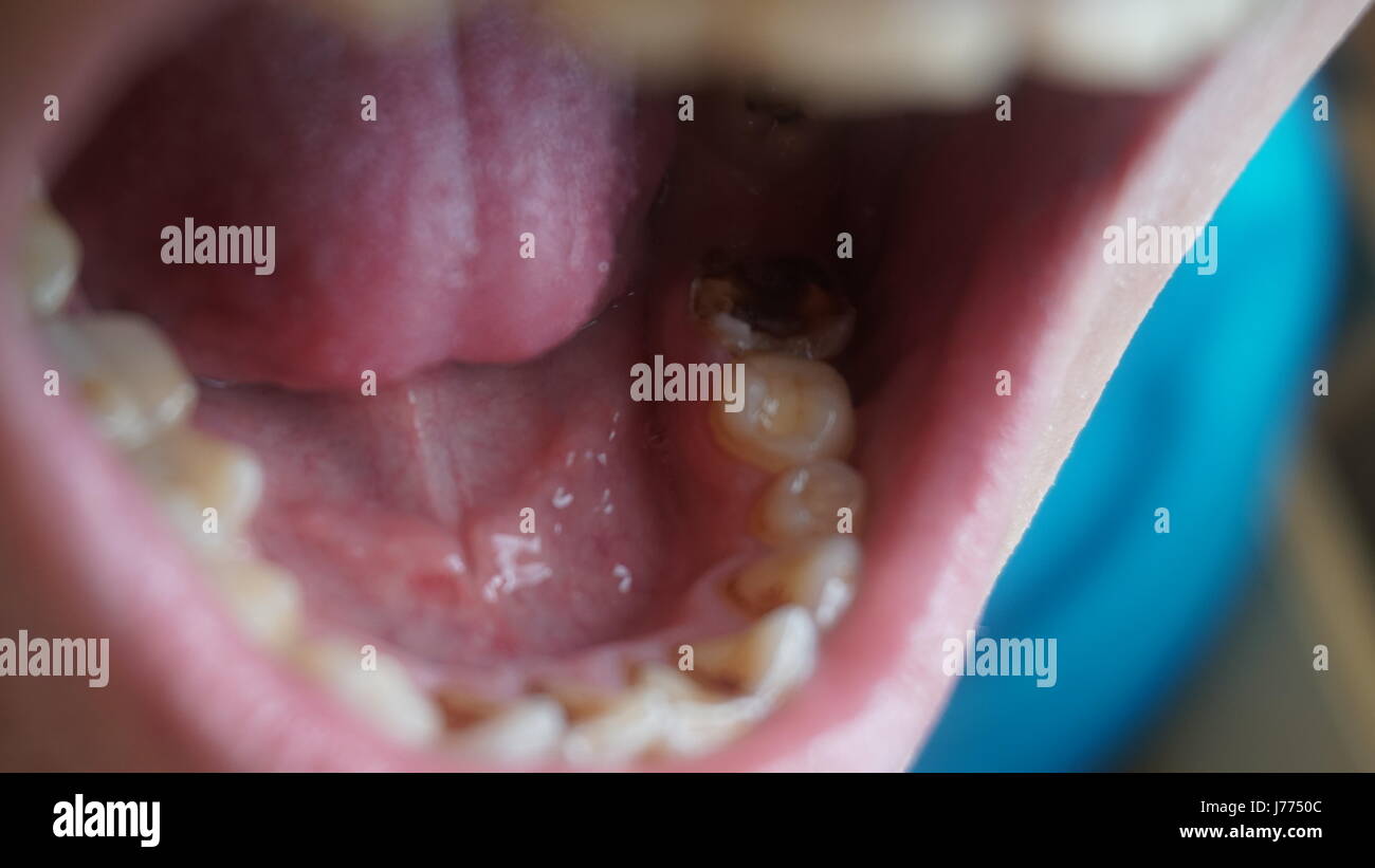 Bad teeth of a guy. Rotten and yellow teeth Stock Photo - Alamy