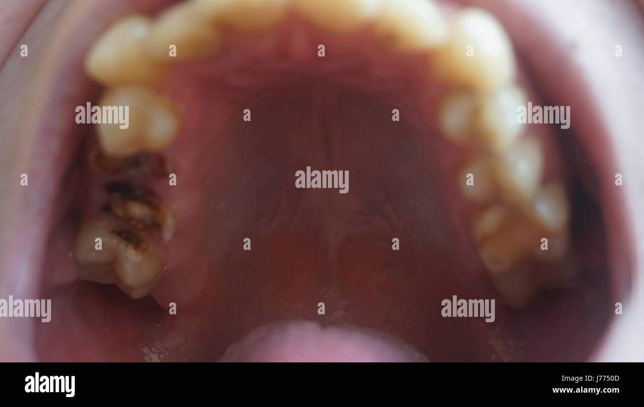 Treating gum disease hi-res stock photography and images - Alamy