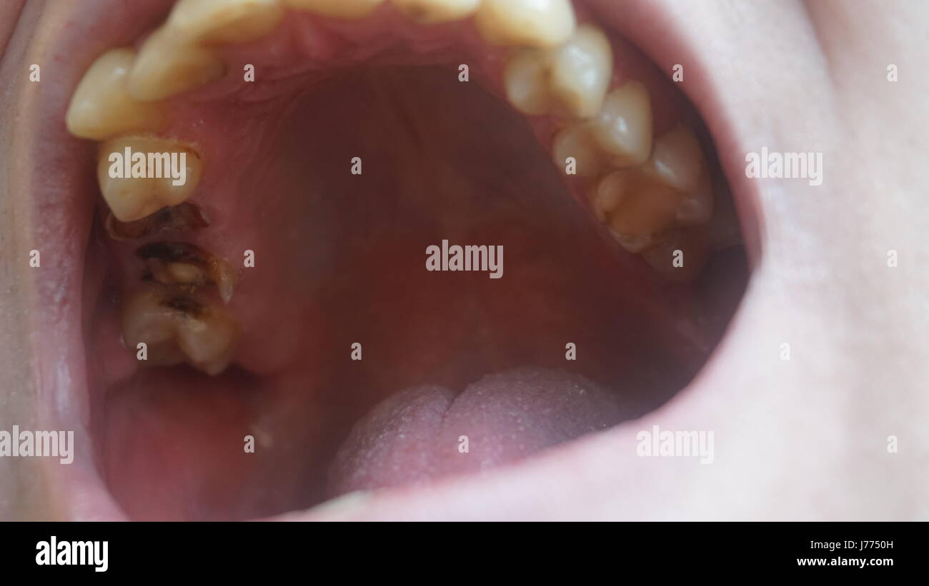 Bad teeth of a guy. Rotten and yellow teeth Stock Photo - Alamy