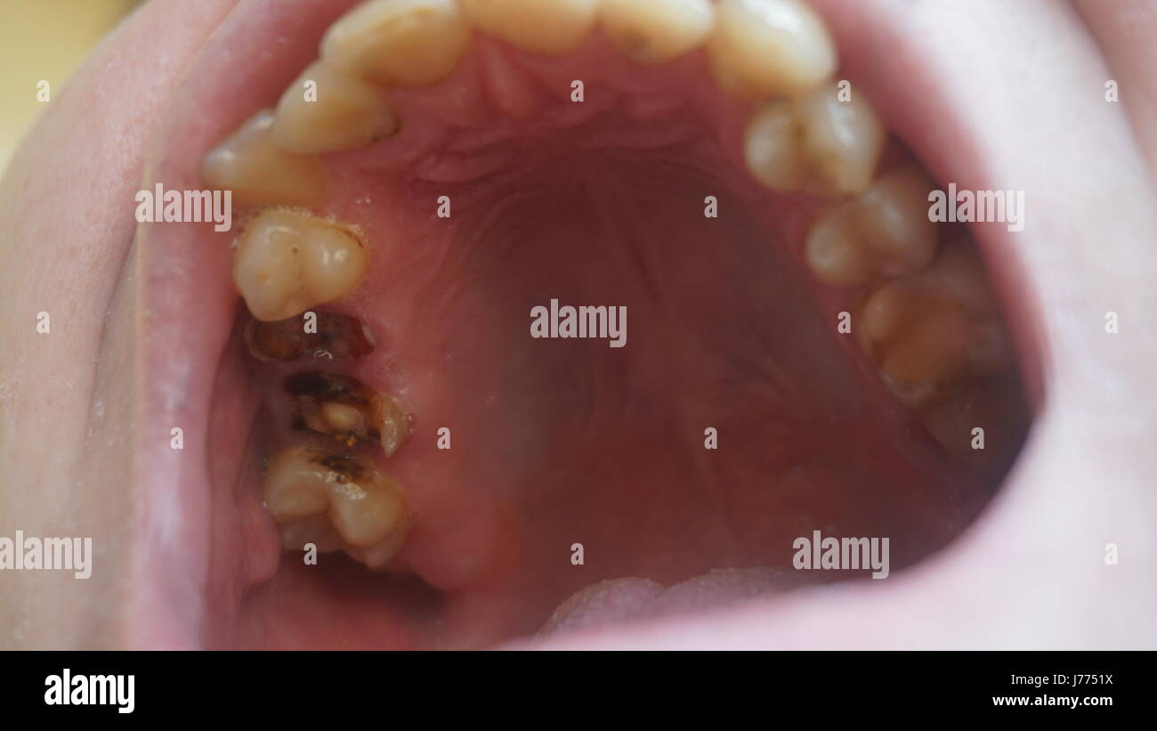 Bad teeth of a guy. Rotten and yellow teeth Stock Photo - Alamy